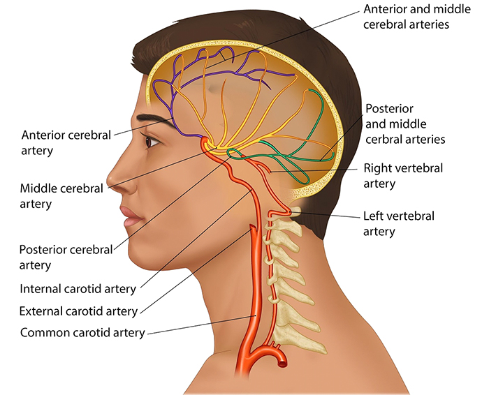 Post stroke Dysphagia